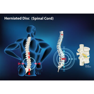 Disc Problems: Causes, Symptoms, and Treatments - Global Healthcare India