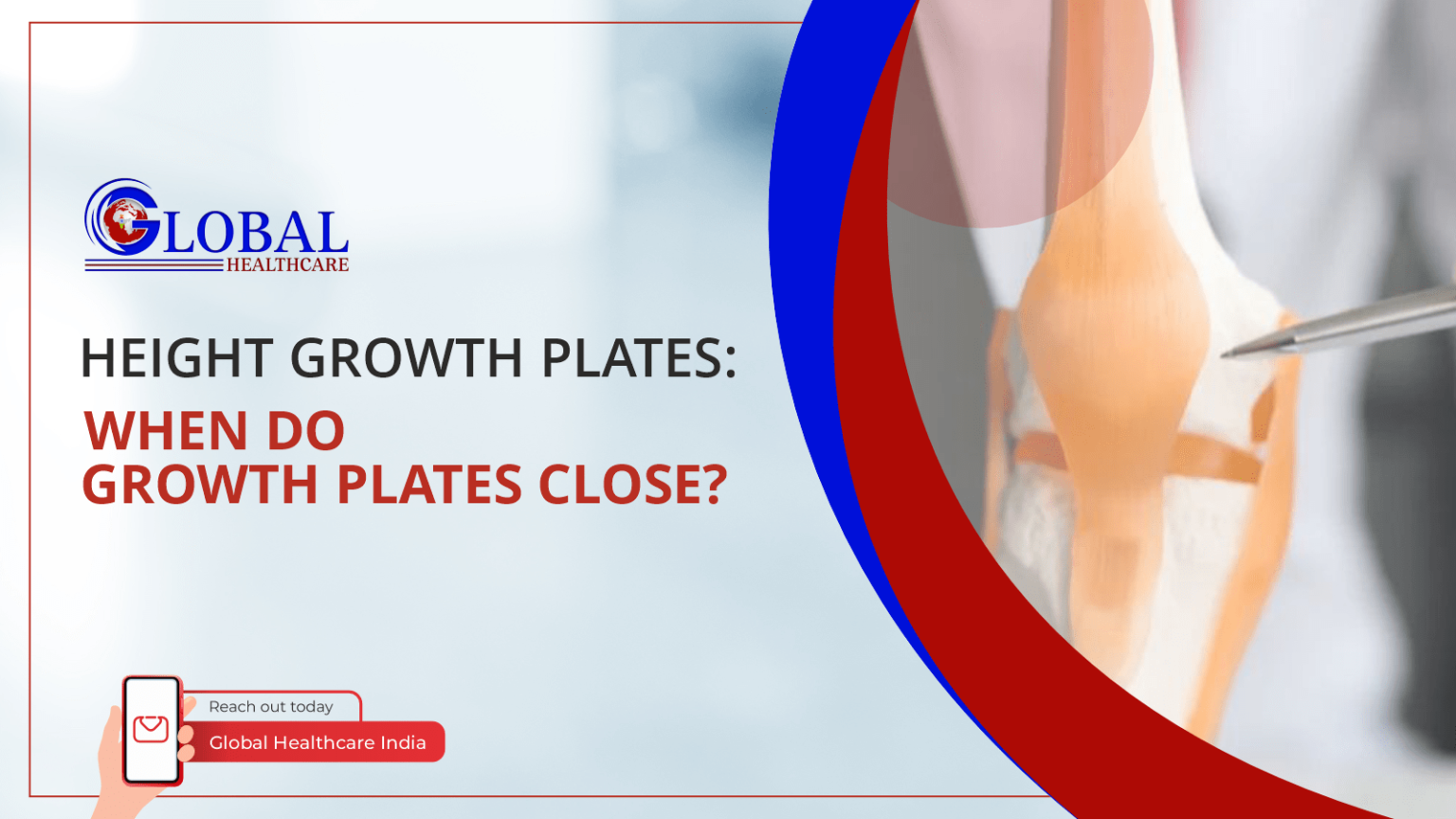 Height Growth Plates: When Do Growth Plates Close? – Global Healthcare ...